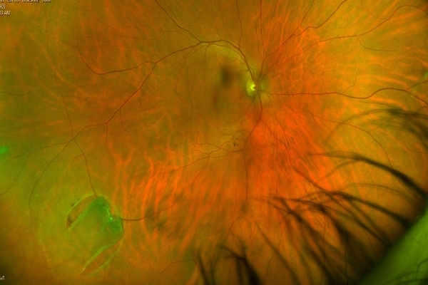 Daytona Optos (Latest) | Edgbaston Eye Clinic