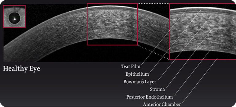 Digital Pachymetry | Edgbaston Eye Clinic